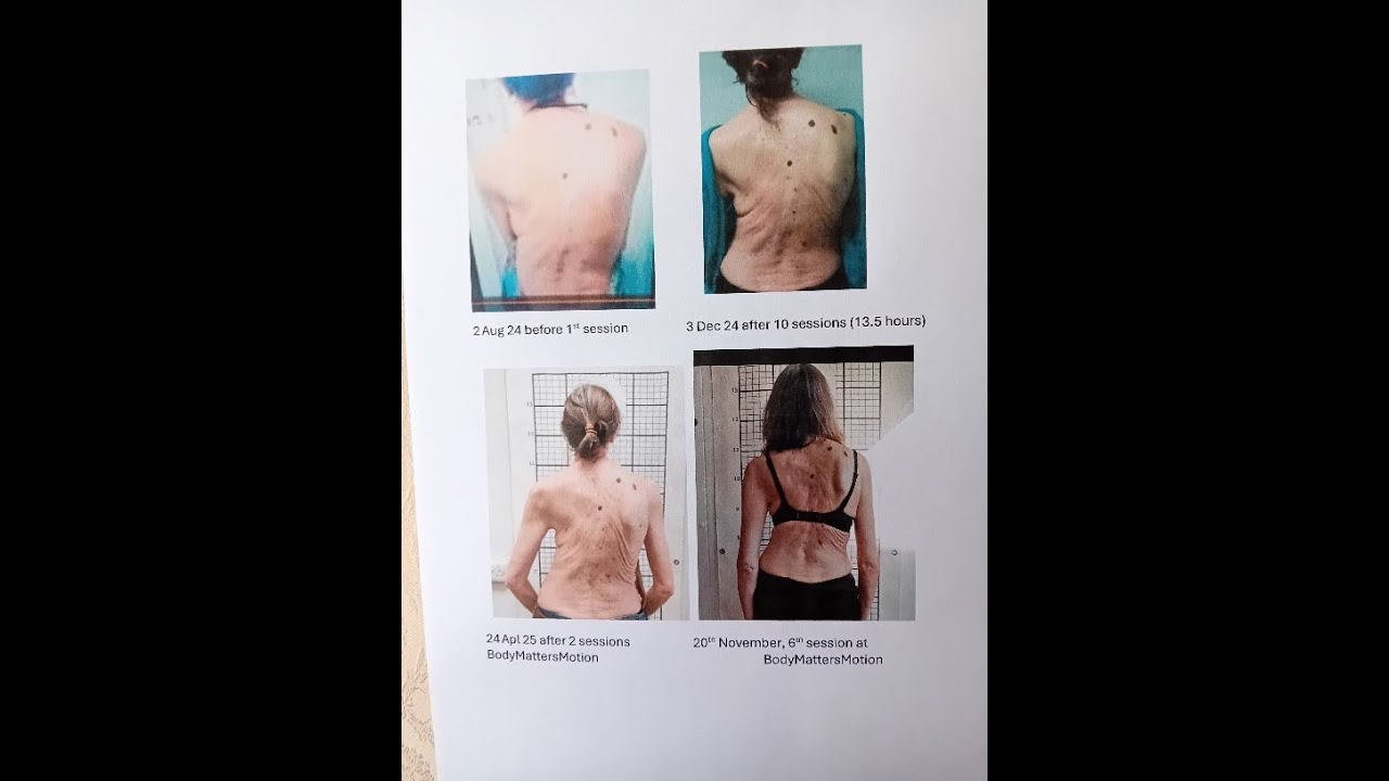 PART 1 20/11/25 ASMI - Assisted Spinal Mobilisation Instrument therapy ...