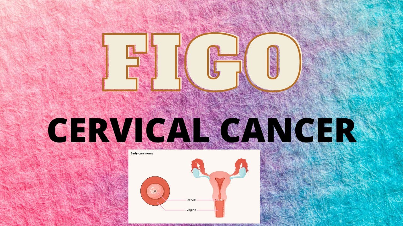 Staging of Carcinoma Cervix - FIGO - Explained Well and Made easy - YouTube