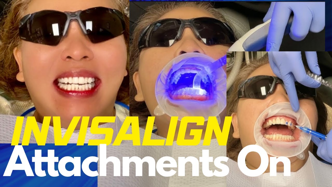 My Invisalign Journey Attachments On First Steps How Its Looks