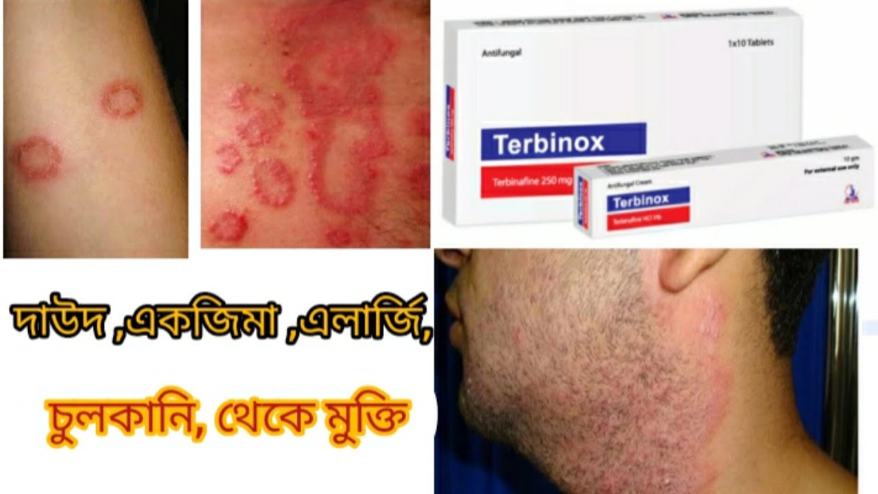 Terbinox 250 Tablet এর কাজ কি, দাউদ, একজিমা, এলার্জি, চুলকানি থেকে ...