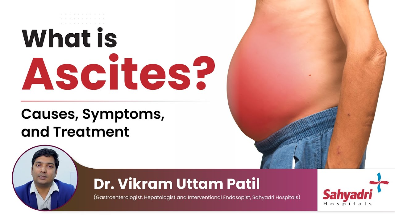 What is Ascites? | Causes, Symptoms, and Treatment | Dr Vikram Uttam ...