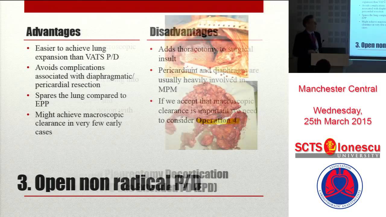 Extended pleurectomy decortication - YouTube