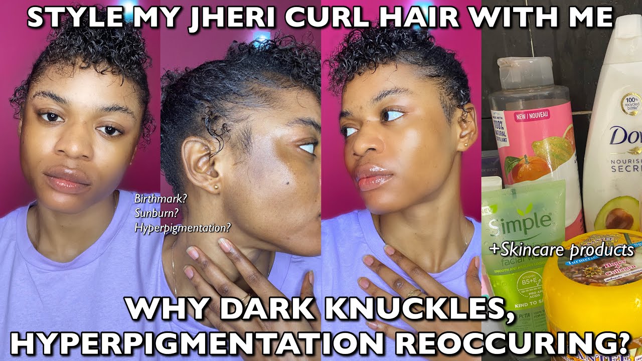 Let’s talk about my dark knuckle, Hyperpigmentation + Style my Jheri ...