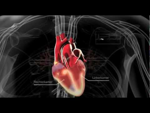 Een hart met atriumfibrilleren - YouTube