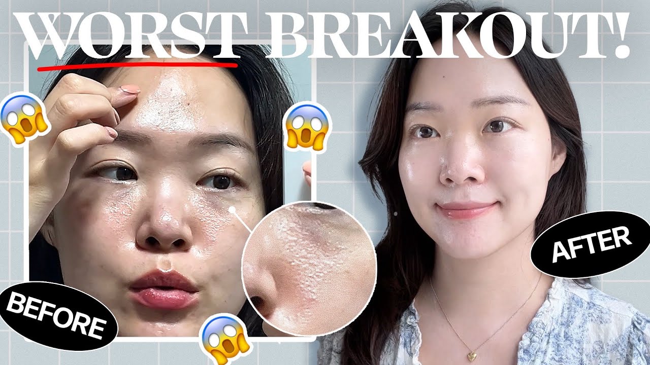 WORST BREAKOUT EVER?! What to do when your skin starts FREAKING OUT ...