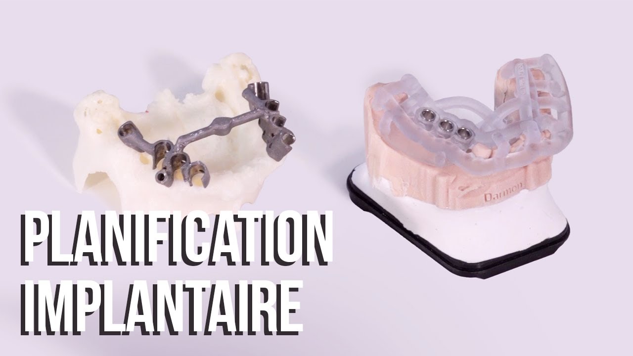 🦷 Tuto implanto #3 : la planification implantaire - YouTube