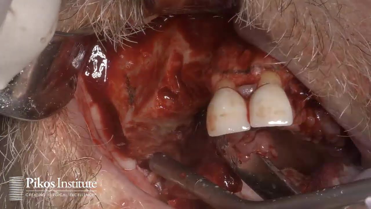 All on X Maxillary Surgery with Autogenous Bone Harvest and Bone Graft ...