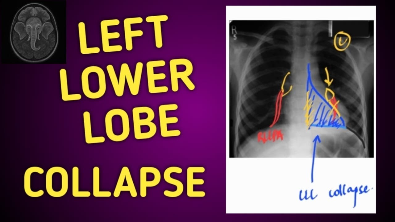 LEFT LOWER LOBE Collapse! How does it appear on chest xray ? - YouTube
