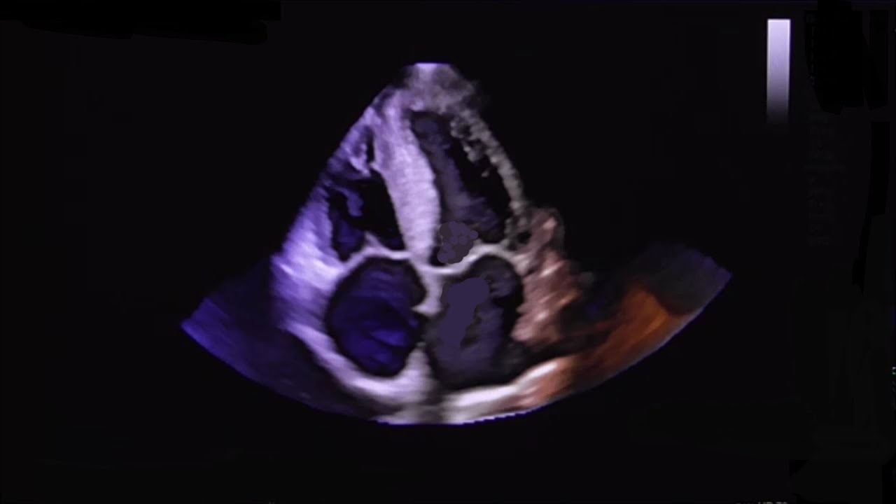 AL (Light Chain) Cardiac Amyloidosis by Multiple Myeloma - YouTube