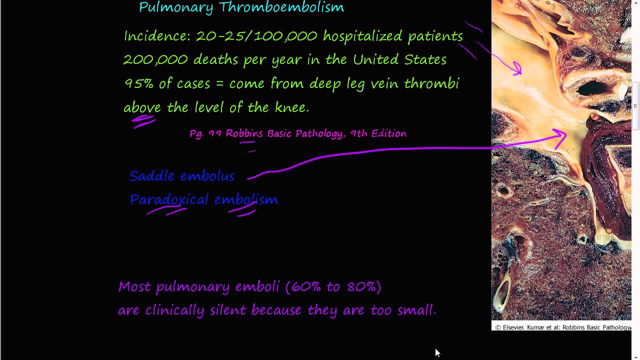 #58P-Etiology of Pulmonary embolism, Saddle embolus, Paradoxial ...