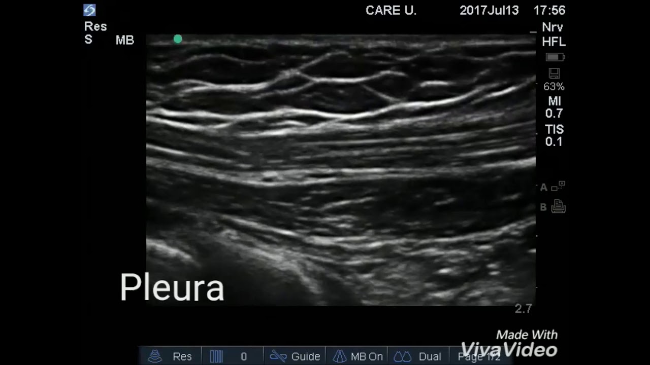 USG guided PEC1 block - YouTube