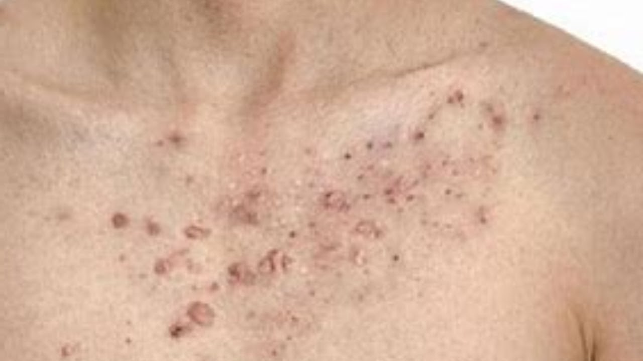 Blackhead Removal On CHEST ACNE Treatment For Blackheads Whiteheads blackhead-removal-on-chest-acne-treatment-for-blackheads-whiteheads