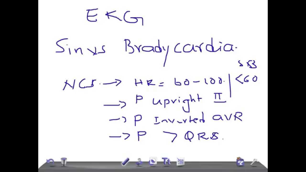 EKG/ECG made simple & easy: Sinus bradycardia - YouTube