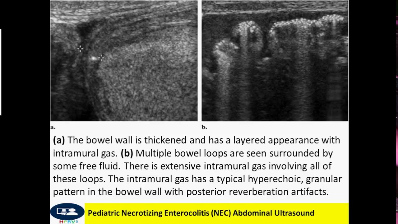 Necrotising enterocolitis (NEC) - YouTube