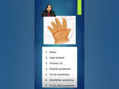 Simian crease Of Down Syndrome Pediatrics - Image based Diagnosis, OSCE, Spot - Shorts - YouTube