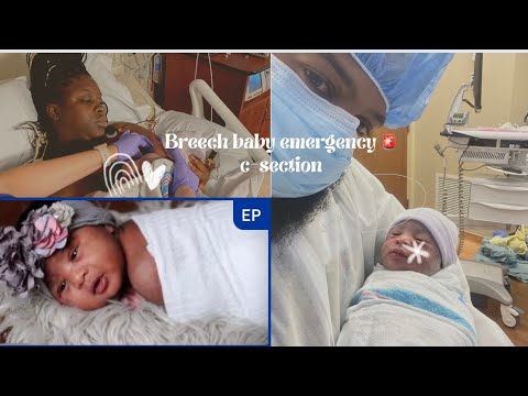 My Labor and delivery breech baby story| ruptured membrane | emergency ...