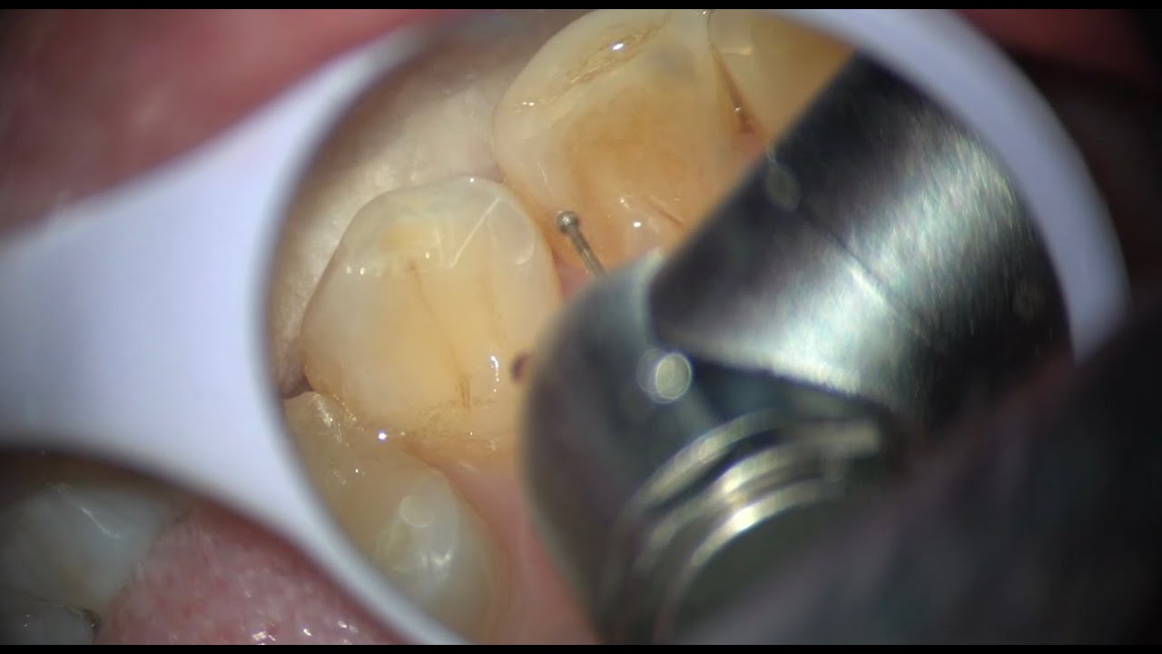 Class III cavity preparation Upper Lateral Incisor - YouTube