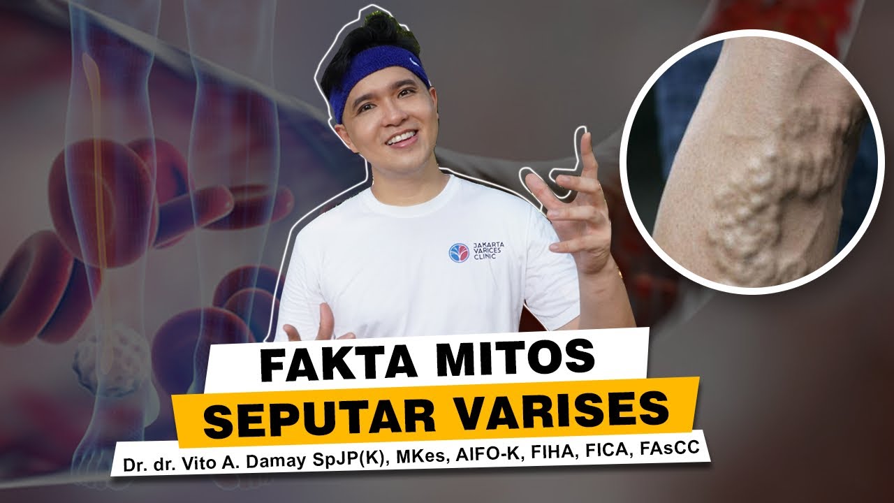 Dr Vito | Fakta Mitos Seputar Varises - YouTube