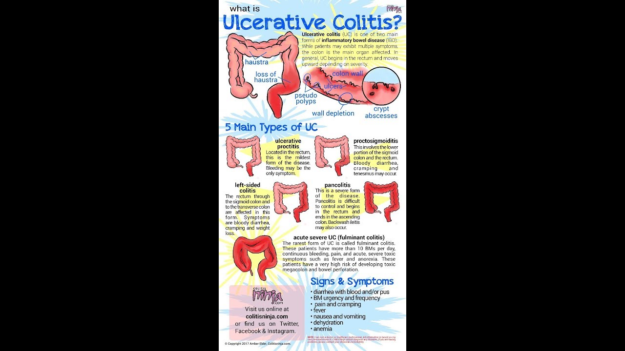 complications of Ulcerative Colitis????????????? - YouTube