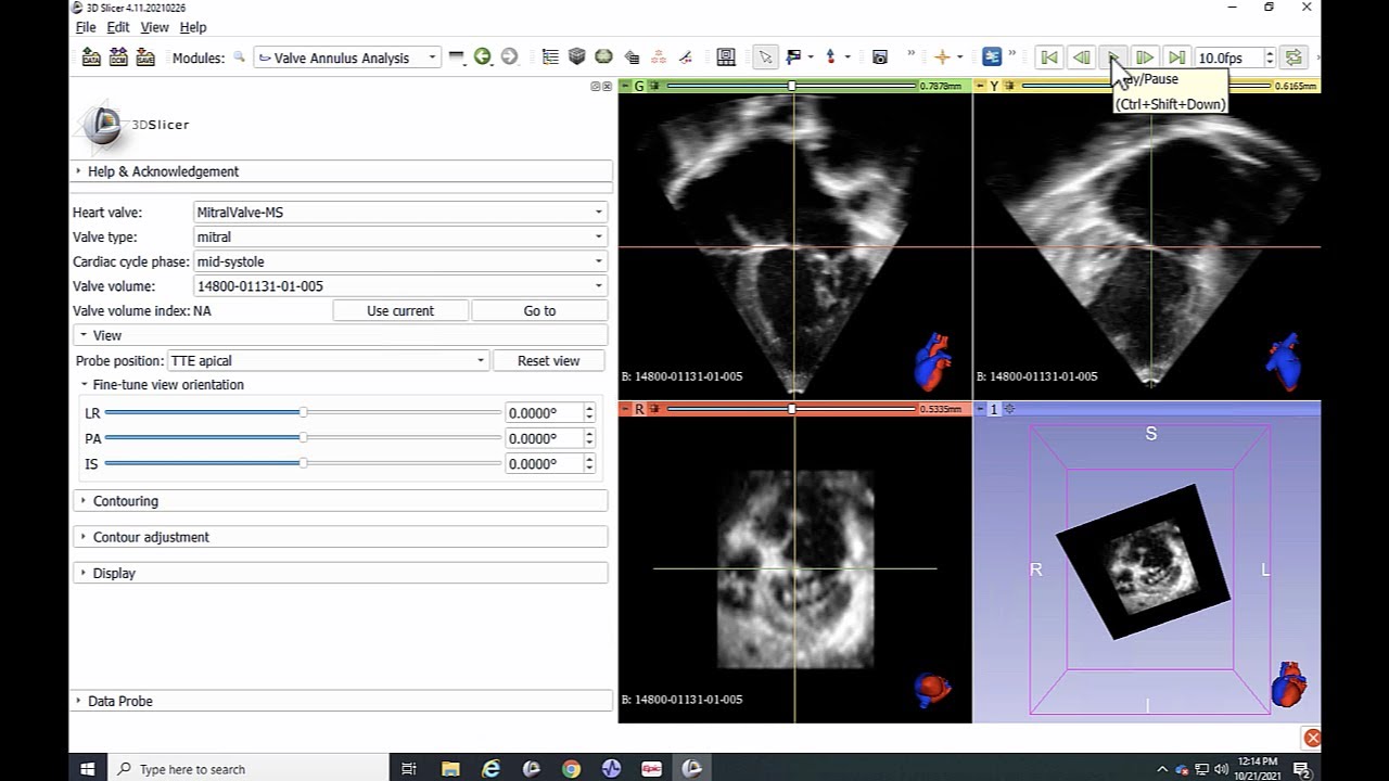 SlicerHeart: Data Import and Visualization in 3D Slicer - YouTube