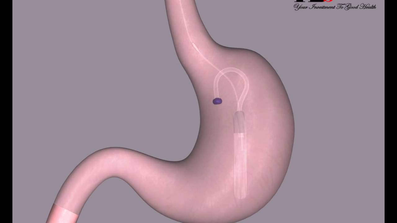 Understanding Gastric Balloon: A Non-Surgical Approach to Weight Loss ...