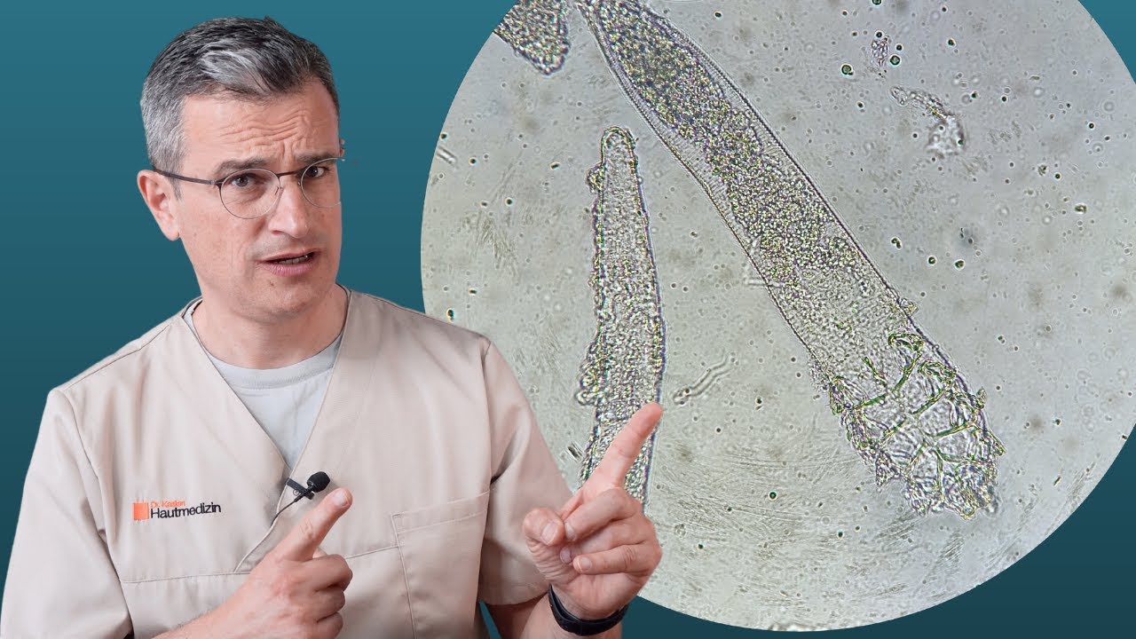 Was tun gegen Haarbalgmilben? 🐜 So wird die Haut wieder rein! 💡Dr ...