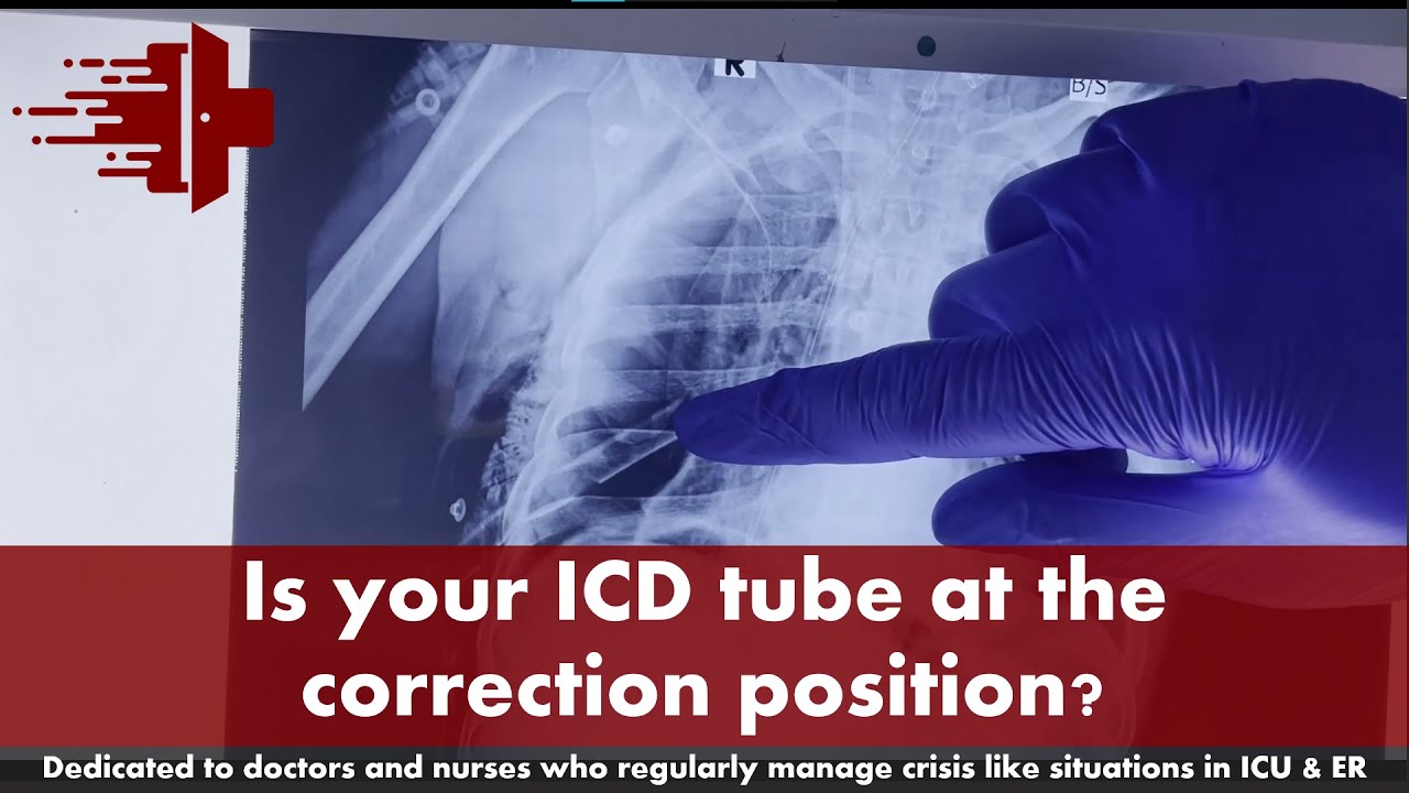 Is your ICD tube at the correction position? | regularcrisis - YouTube