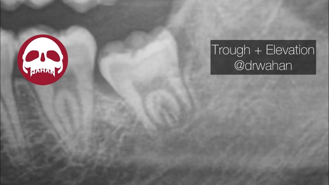 Buccal Trough and Elevation of Wisdom Tooth Partial Bony Impaction ...