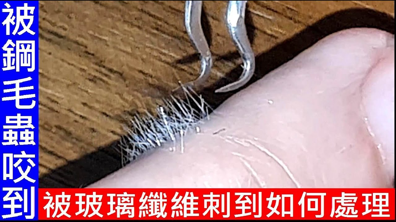 手被玻璃纖維刺到如何處理【What to do if your skin is punctured by fiberglass】被海水鋼毛蟲咬 ...