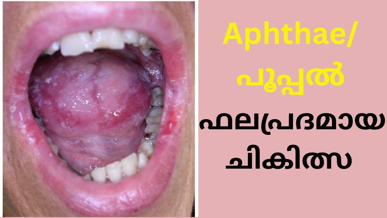 Aphthae/ പൂപ്പൽ ഫലപ്രദമായ ചികിത്സ - YouTube