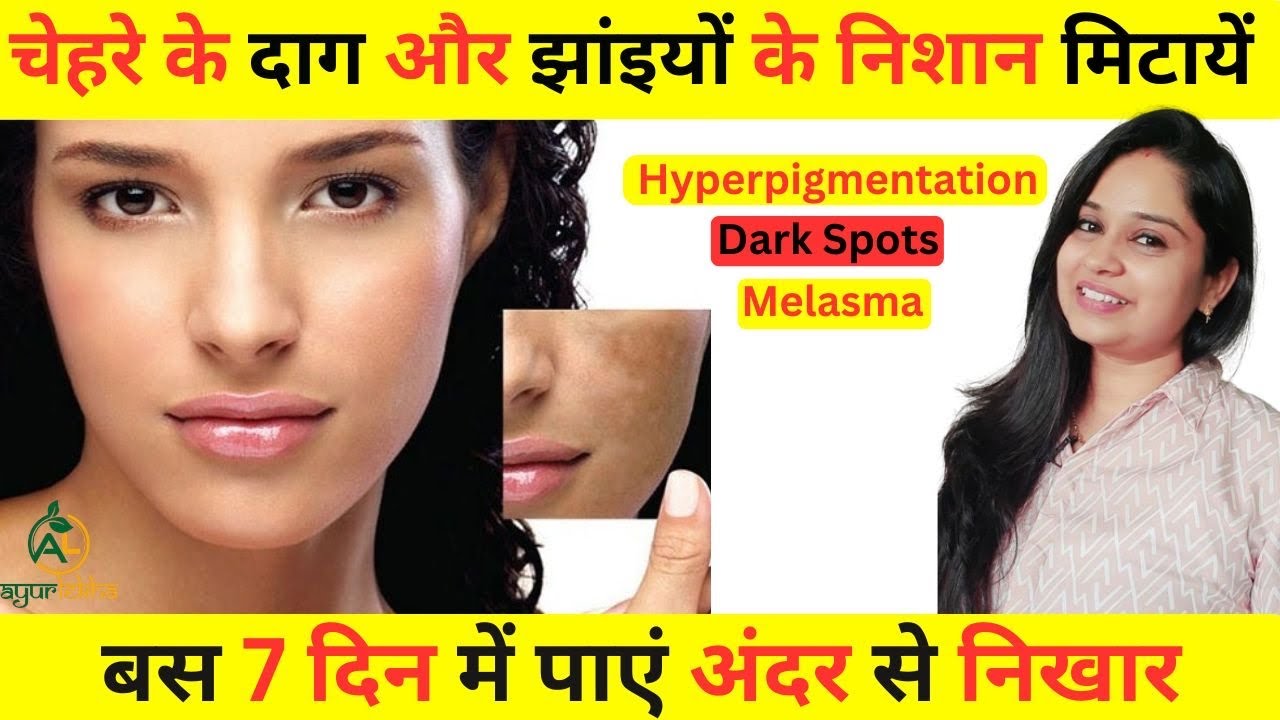 How to Get Rid of Melasma Naturally | Homemade Cream for Dark Spots ...