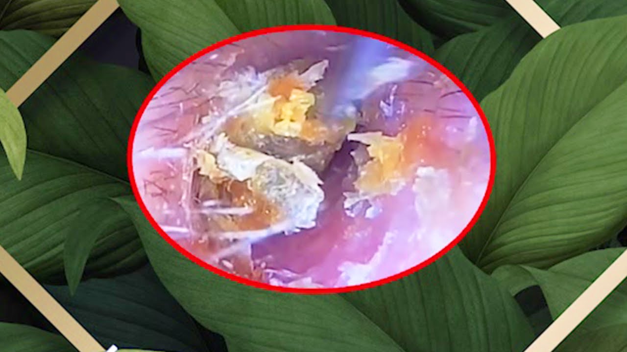 821 Severely Squashed Ear Wax Removal - YouTube