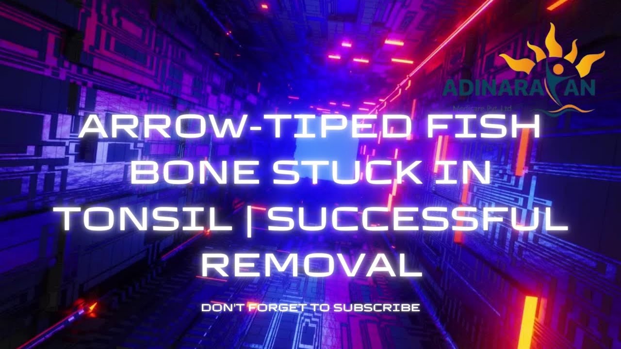 Arrow-Tiped Fish Bone Stuck in Tonsil | Successful Removal - YouTube