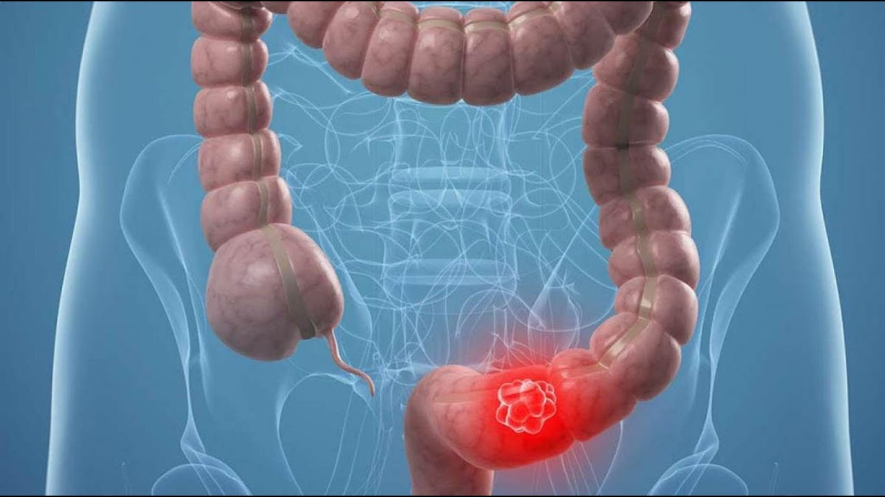 COMO PUEDES LAVAR EL COLON NATURALMENTE - YouTube