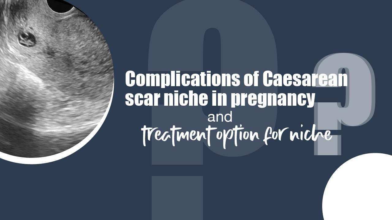 Complications of Caesarean scar niche in pregnancy. Treatment options ...