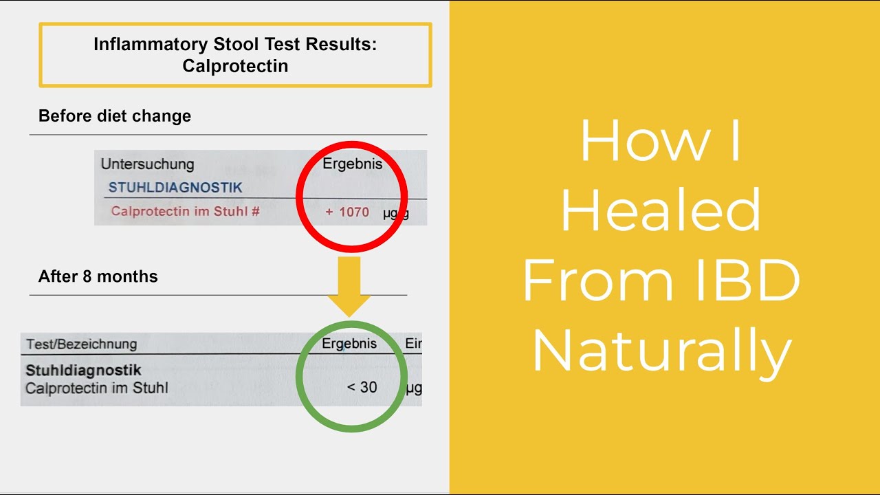 How I Healed From IBD (Ulcerative Colitis) Naturally - My Story - YouTube