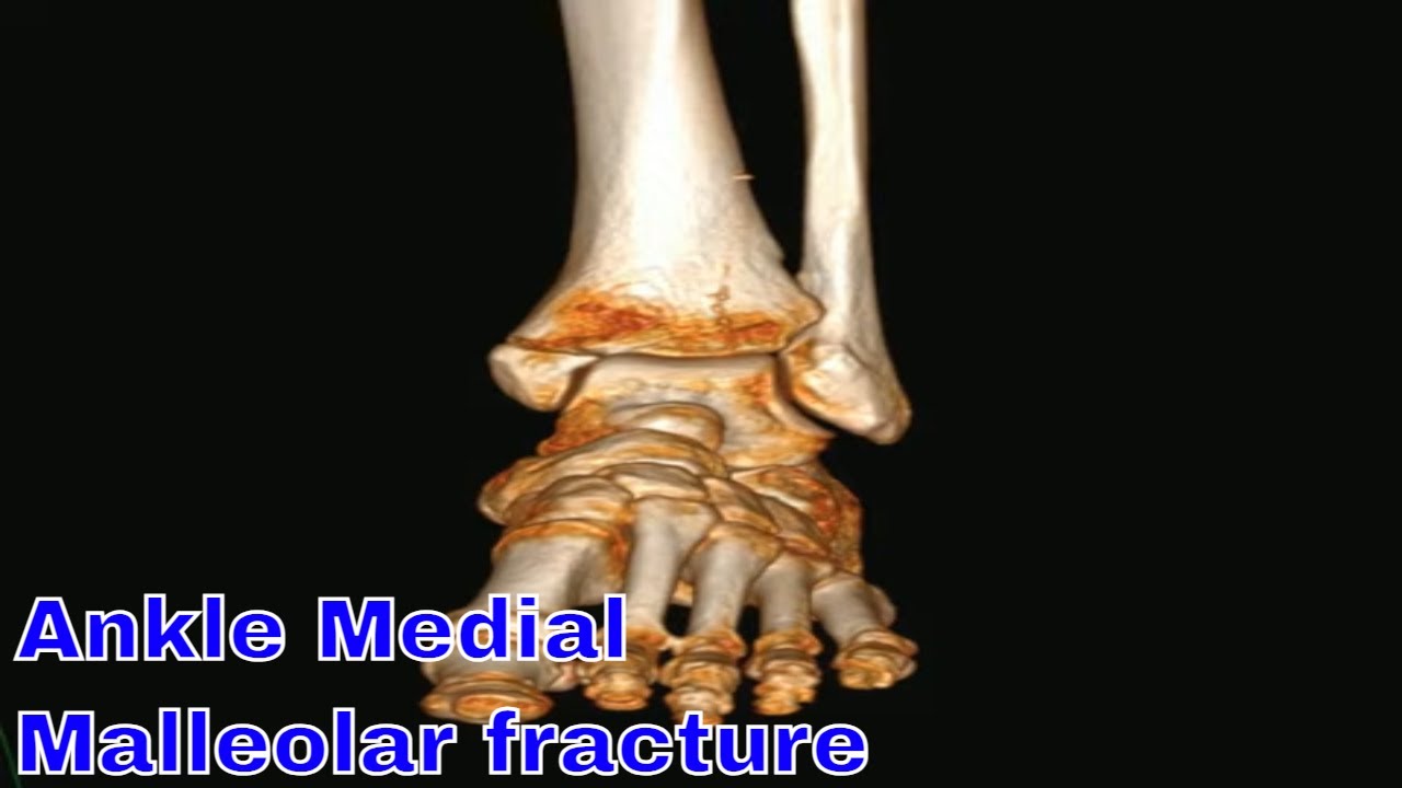 Ankle Medial Malleolar fracture - YouTube