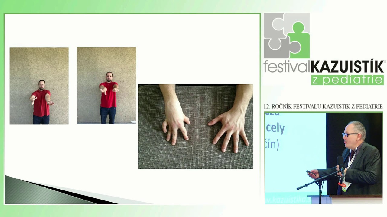 48 Akútna hemiparéza po prekonaní varicely - YouTube