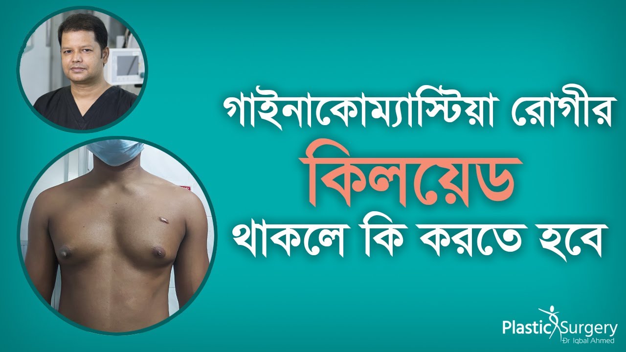 Keloid scar | Gynecomastia surgery scar | Scar treatment | Keloid ...