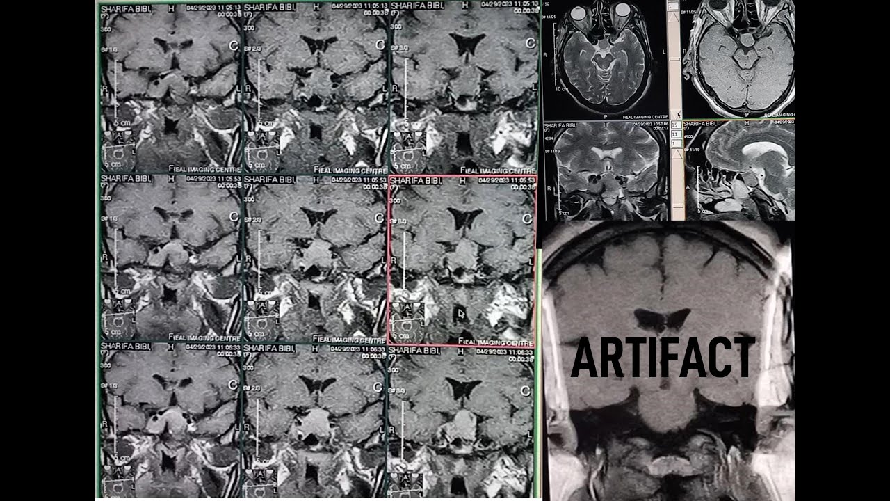 MRI Scan Pituitary gland with Dynamic scan || SFOV Artifacts? || on ...