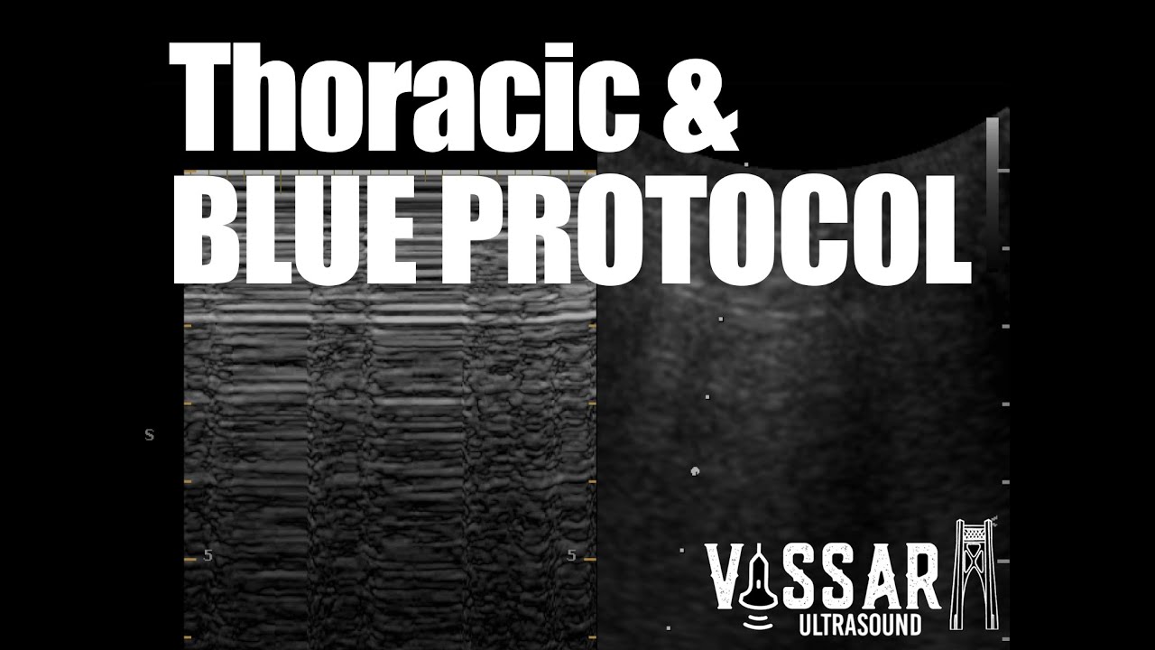 BLUE protocol and Thoracic ultrasound - YouTube