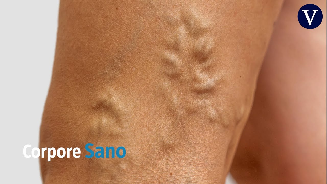 Cómo eliminar las varices de las piernas | Dr. Jorge Planas - YouTube