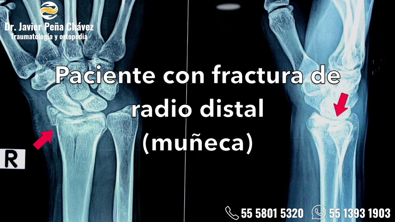 PACIENTE CON FRACTURA DE RADIO DISTAL (MUÑECA) - YouTube