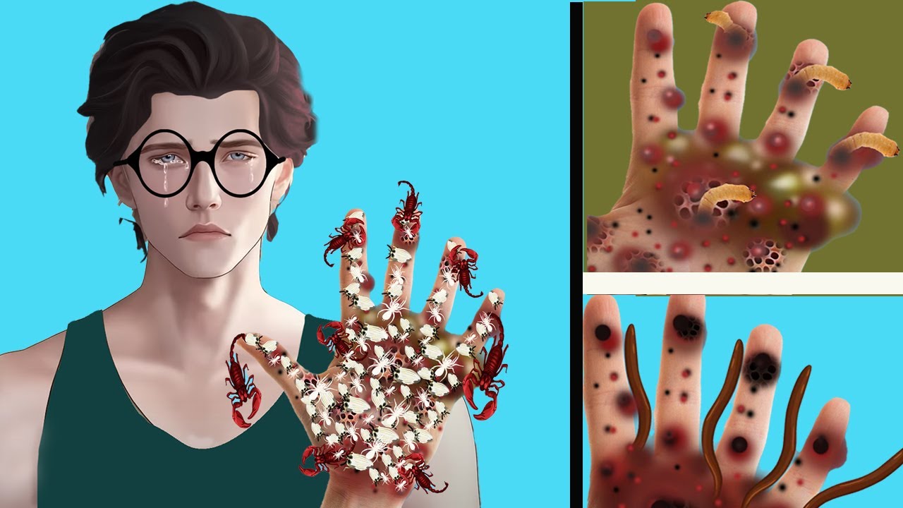 ASMR Treatment for Severe Hand Injury|You Won't Believe What We Found ...