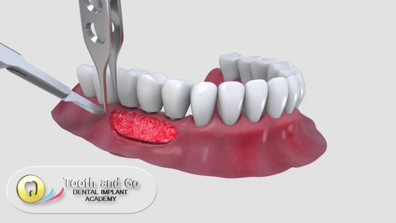 Free Gingival Graft - YouTube