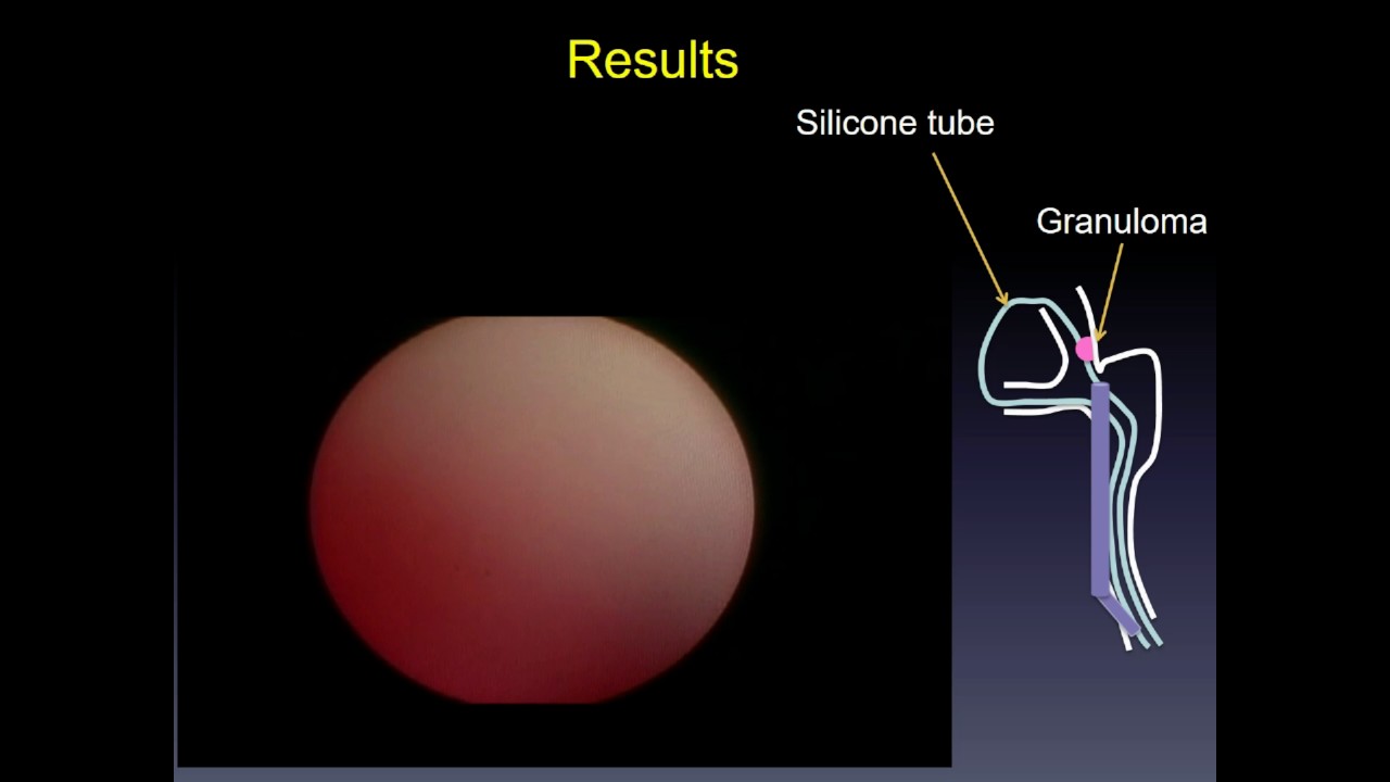 Pressure-controlled air-insufflated high-definition dacryoendoscopy ...