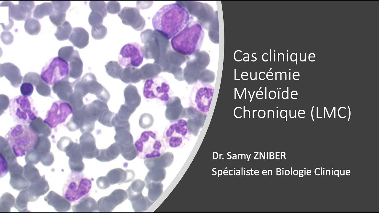 Cas Clinique - Leucémie Myéloïde Chronique (LMC) - YouTube