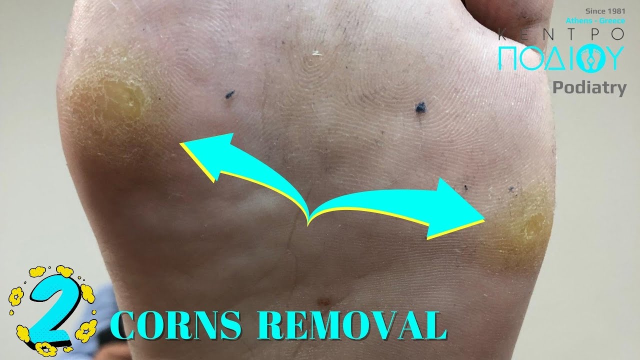 METATARSAL CORN REMOVALS|Αφαίρεση τύλων μεταταρσίων|Κέντρο Ποδιού ...