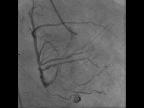 Heart (cardiac) catheterization - YouTube