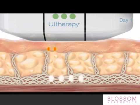 Ulthera - How it Works Animation - YouTube